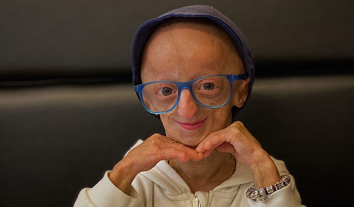 Celulas De Progeria